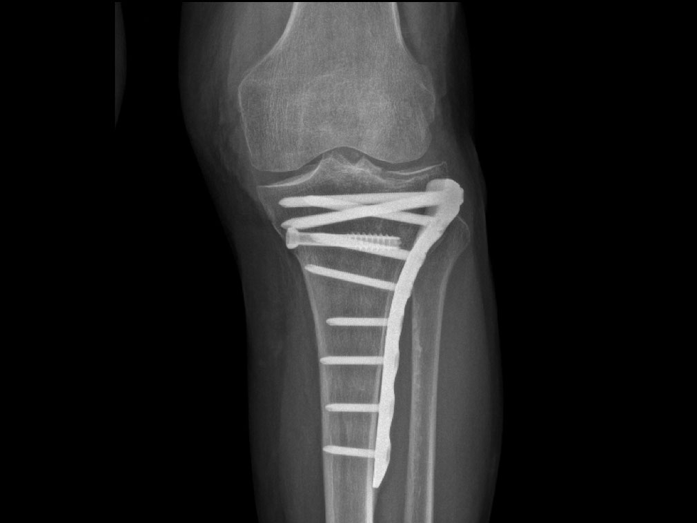 FRACTURES DU GENOU - Dr Rémi : chirurgien orthopédiste à Toulouse