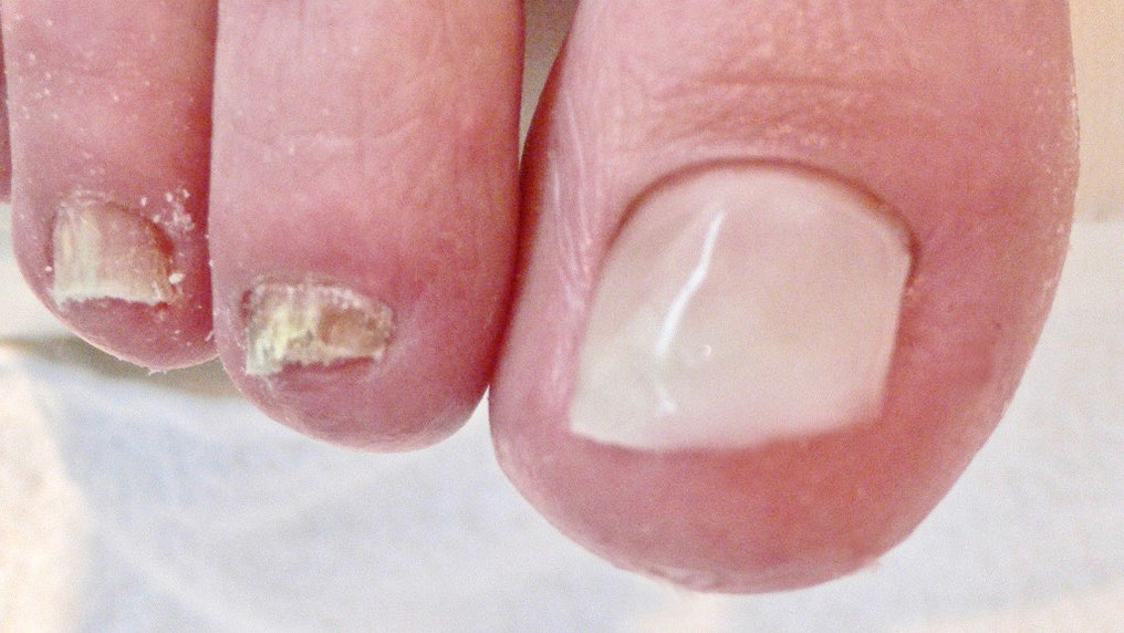 Nagelreparatie - De website van medischpedicuremimi!