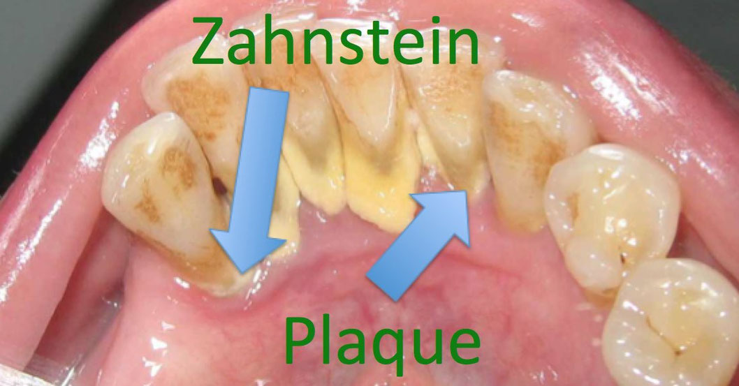 Mundhygiene beim Zahnarzt - Kosten, Dauer, Ablauf & wann es schmerzt ...