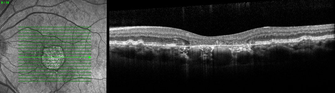 DMLA - Docteur Deneyer Ophtalmologue chirurgie réfractive et cataracte
