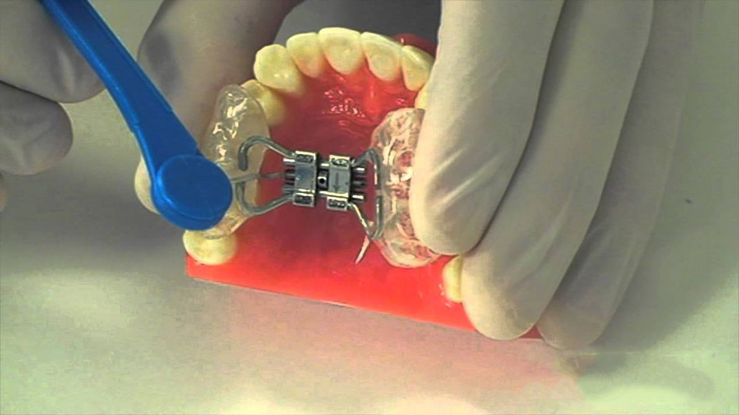 El disyuntor de paladar y sus usos para tu salud dental - Dentista en ...