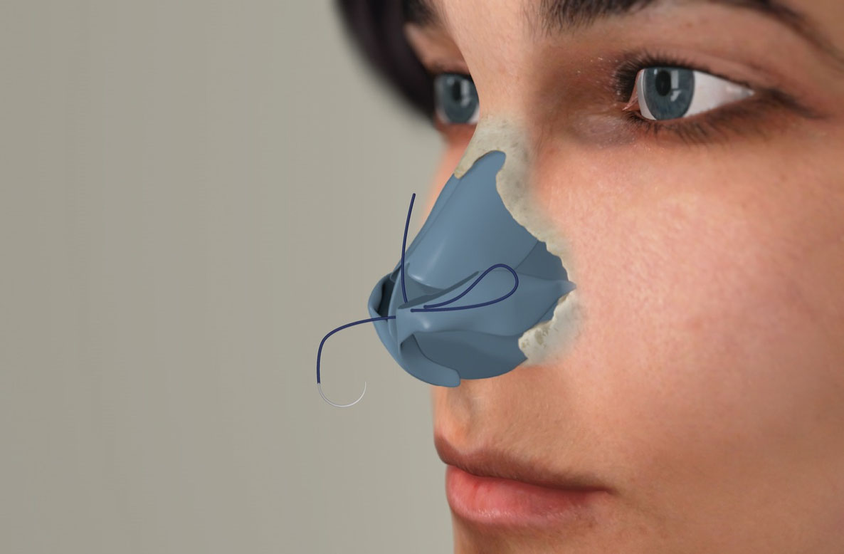 Nose tip correction Hamburg - Dr. Kovacevic