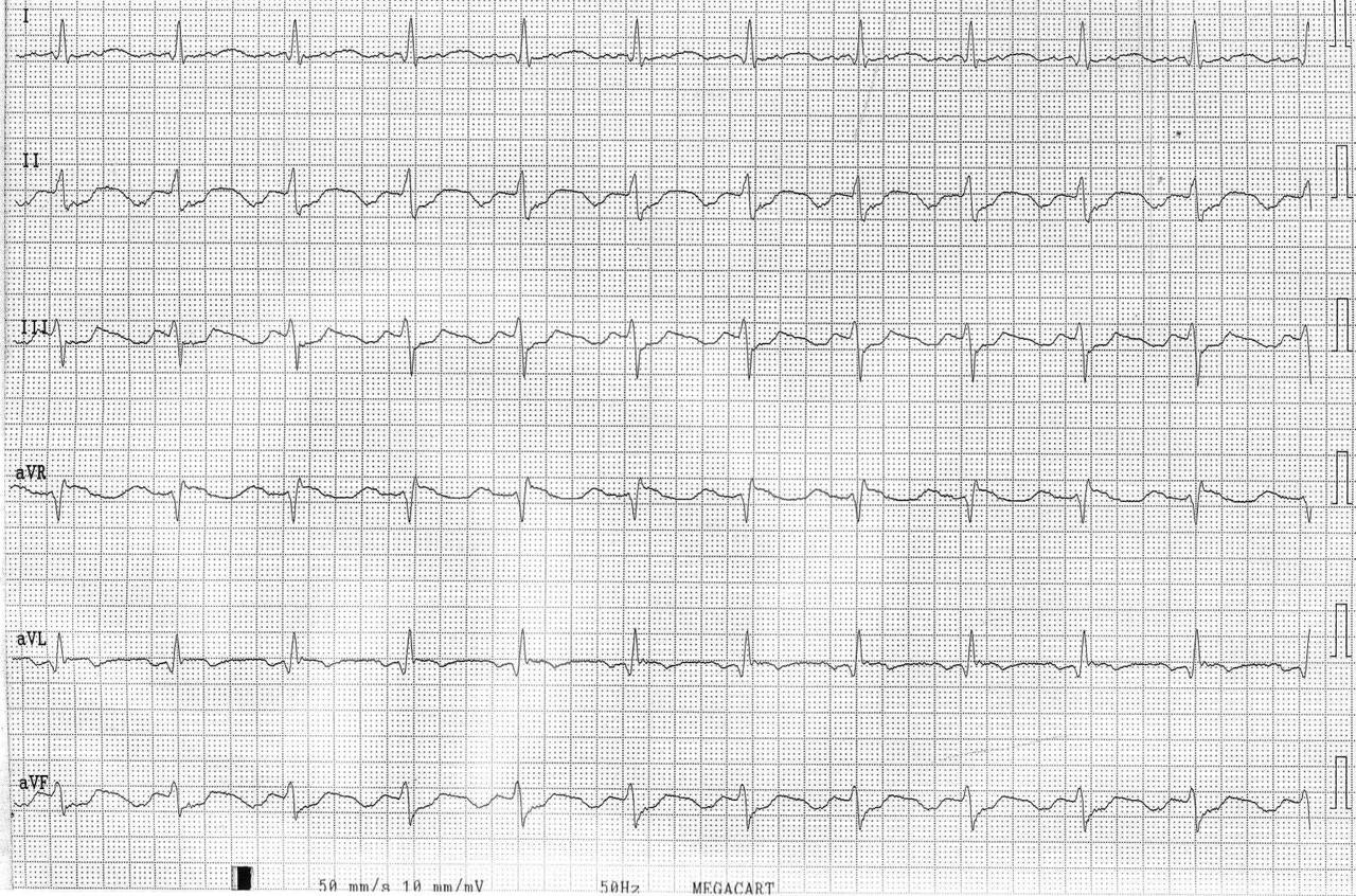 Vorhofflattern - Fokus-EKG