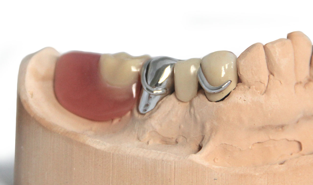 Modellgussprothese - Zahnarztpraxis Dr. Marco Bochmann