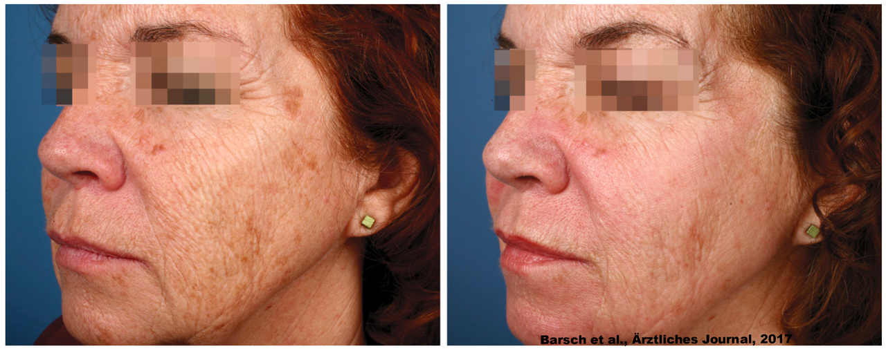 Laser - Falten, Besenreiser, Haare - Dr. Barsch