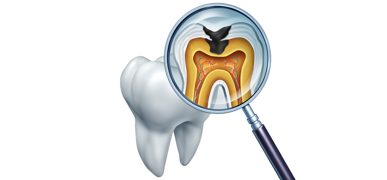Karies: Ursachen, Vorbeugung, Behandlung - Zahnarzt