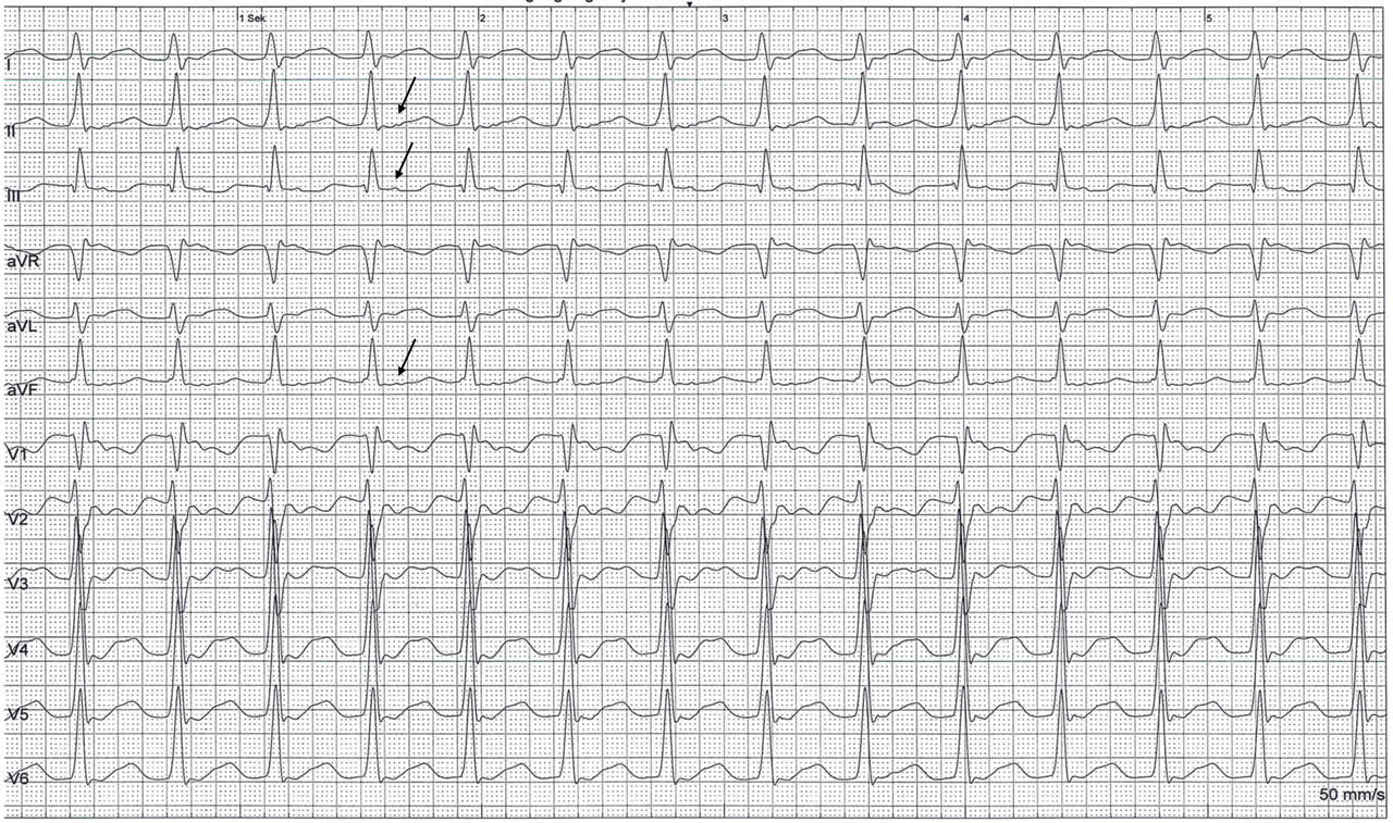 AV-Reentry-Tachykardie und ventrikuläre Präexzitation (WPW-Syndrom ...