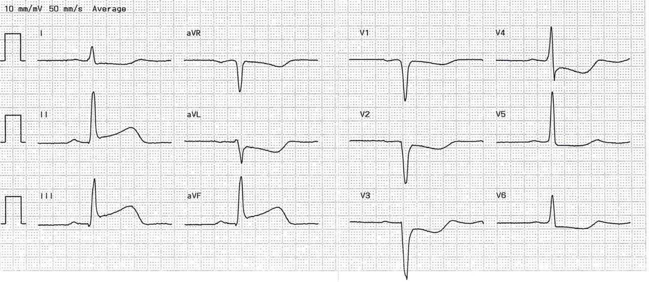 Myokardinfarkt - Fokus-EKG
