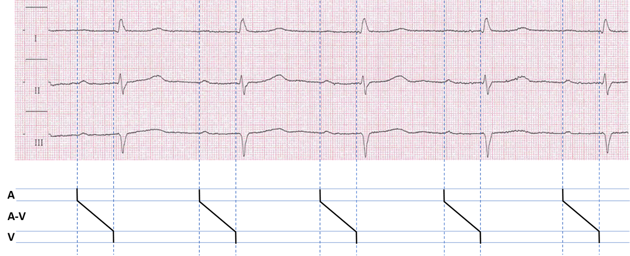 Atrioventrikuläre Blockierungen - Fokus-EKG