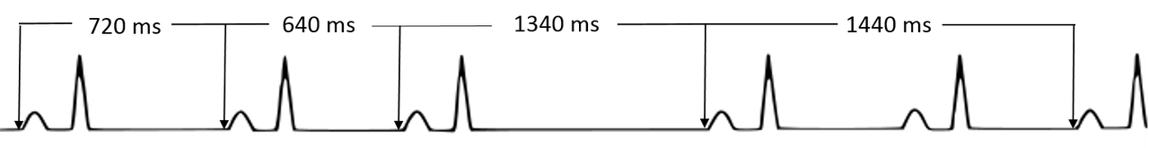 Sinuatriale Blockierungen - Fokus-EKG