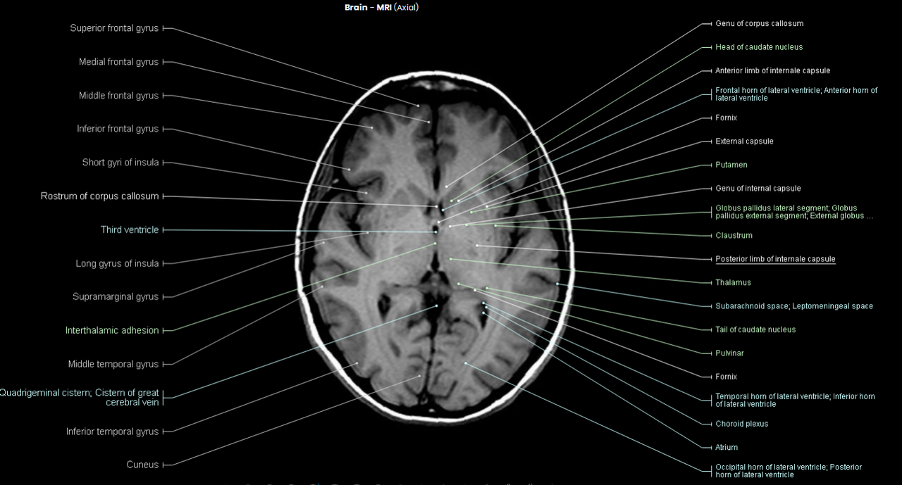 Brain MRI - NeurologyNeeds.com