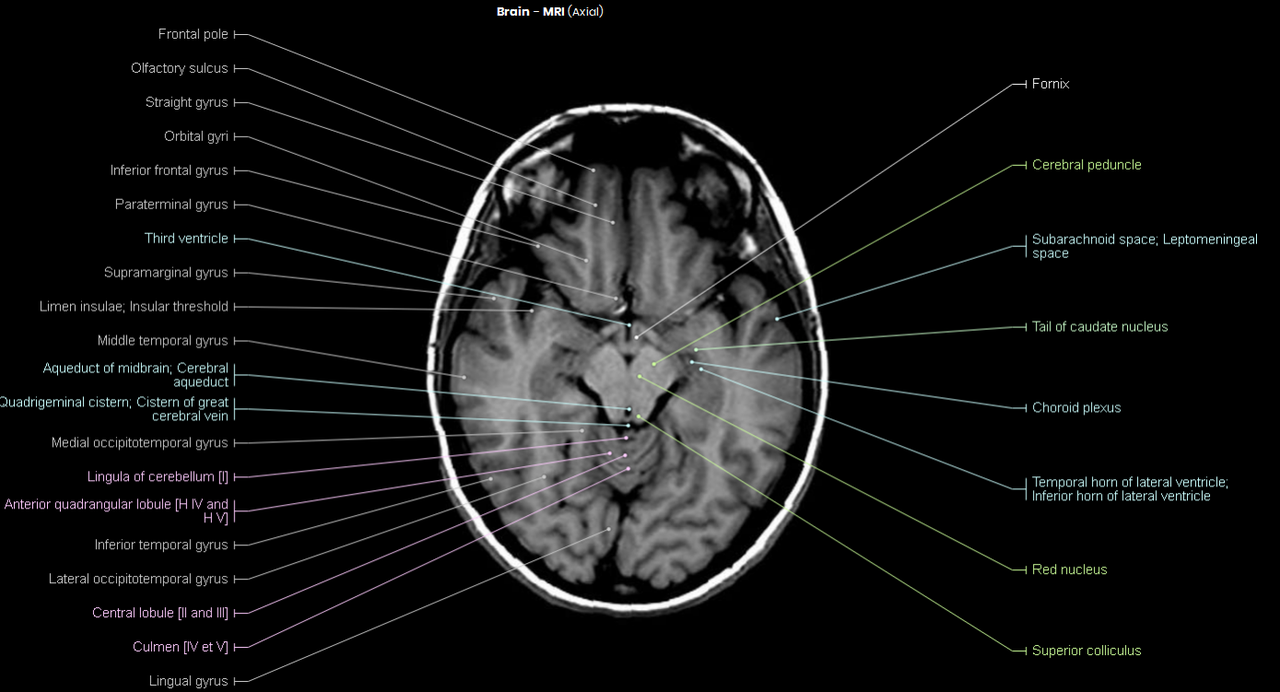 Brain MRI - NeurologyNeeds.com