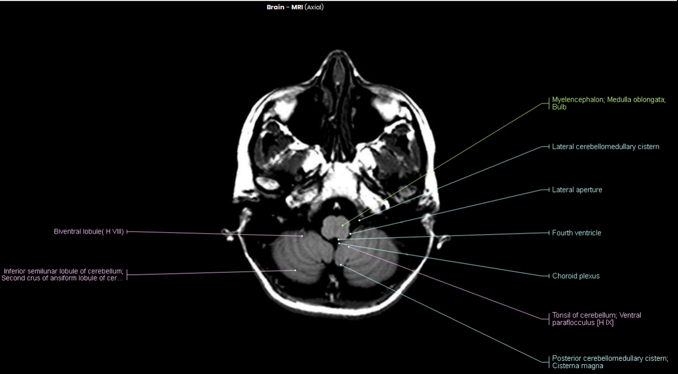 Brain MRI - NeurologyNeeds.com