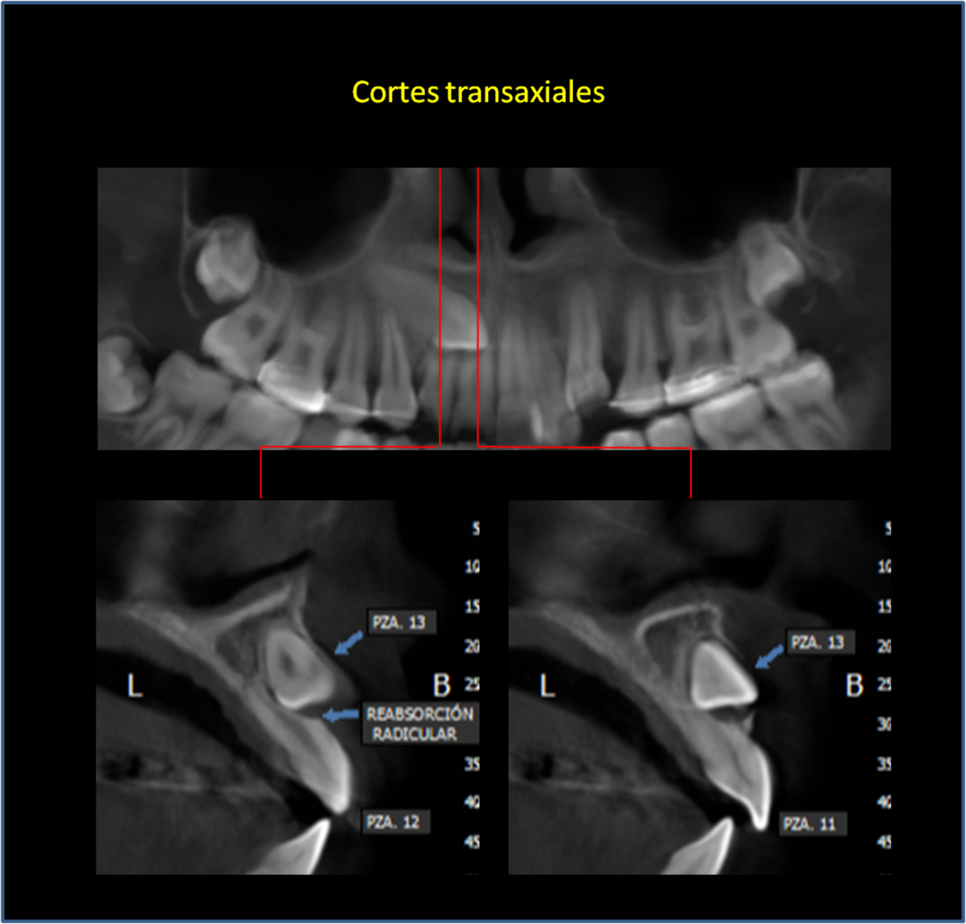 563: Reabsorción radicular externa - CDI