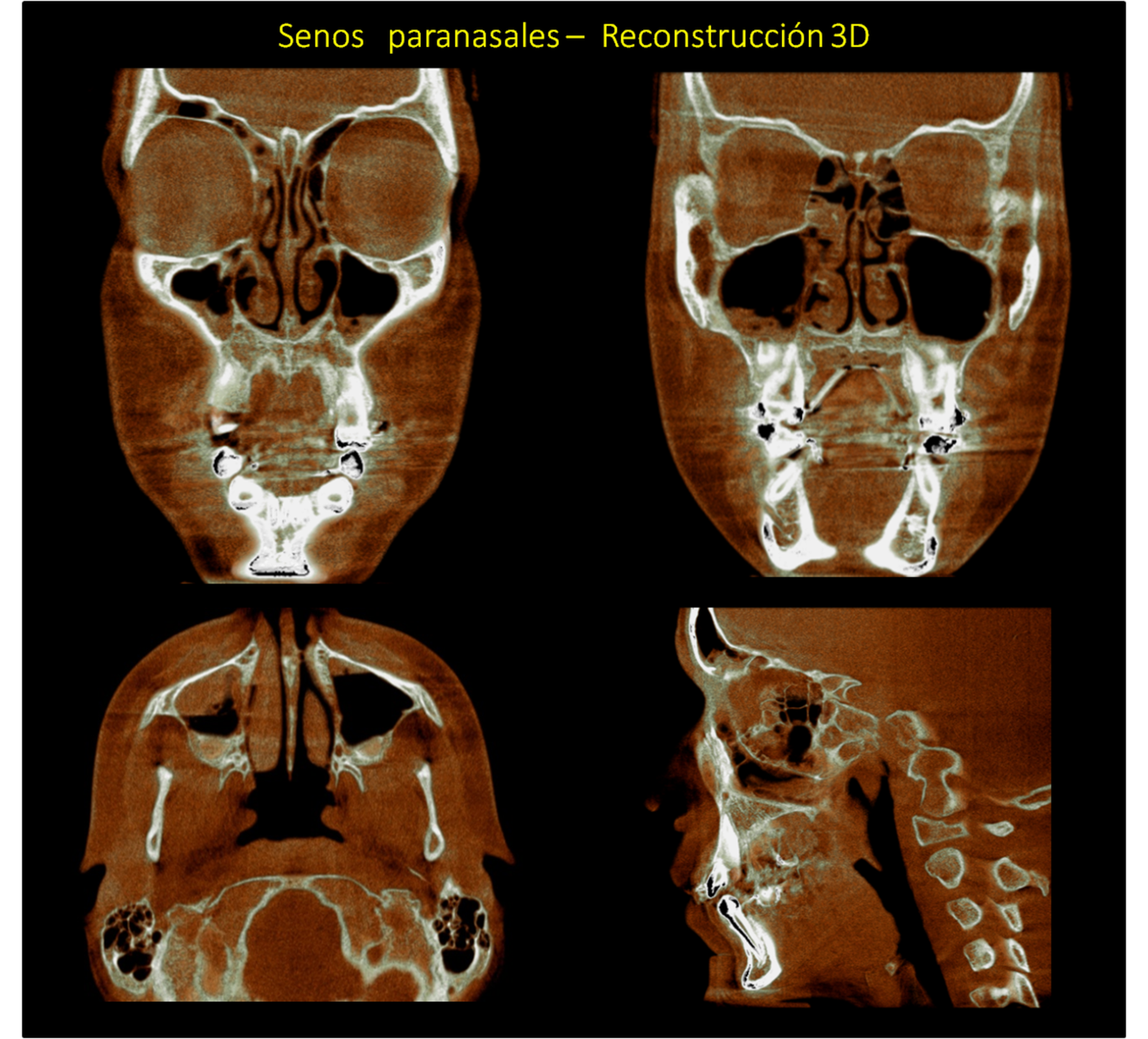 Caso N°557 :Pansinusitis Crónica - CDI