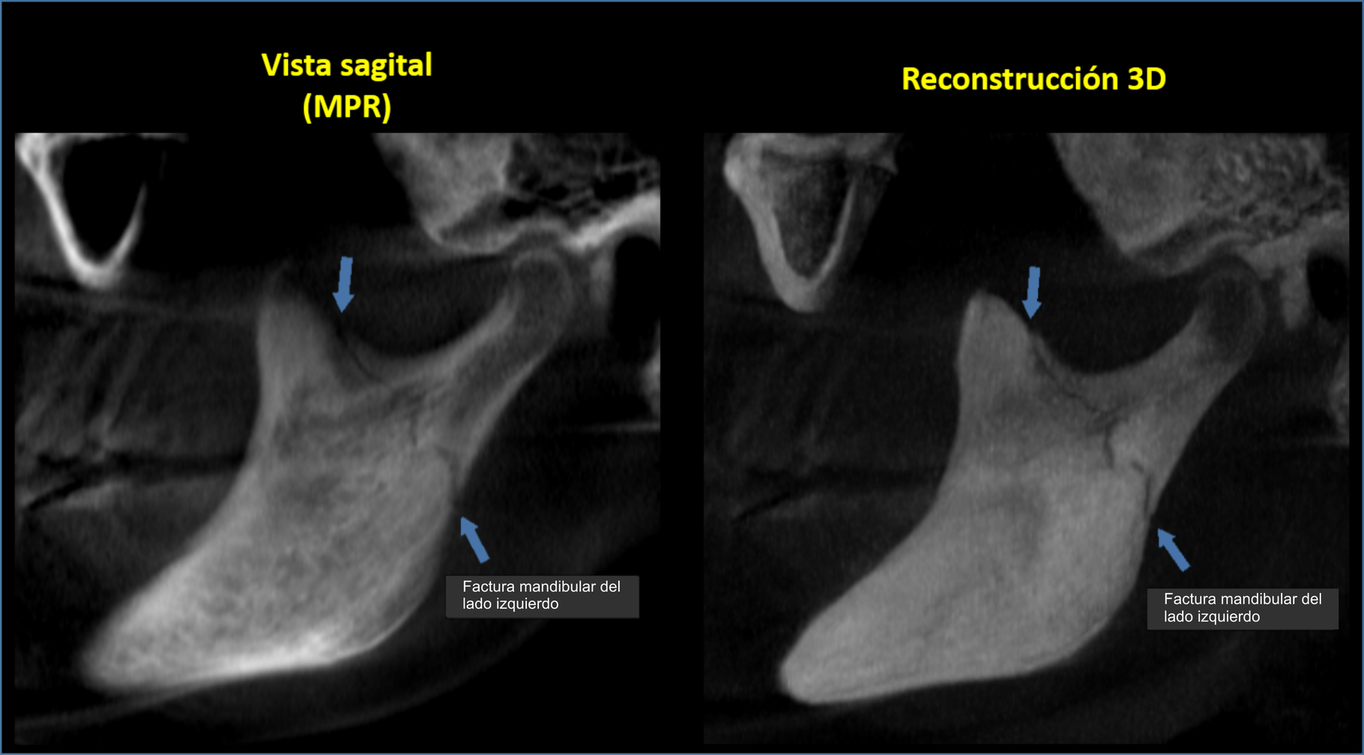 Caso N°560: Fractura Mandibular - CDI