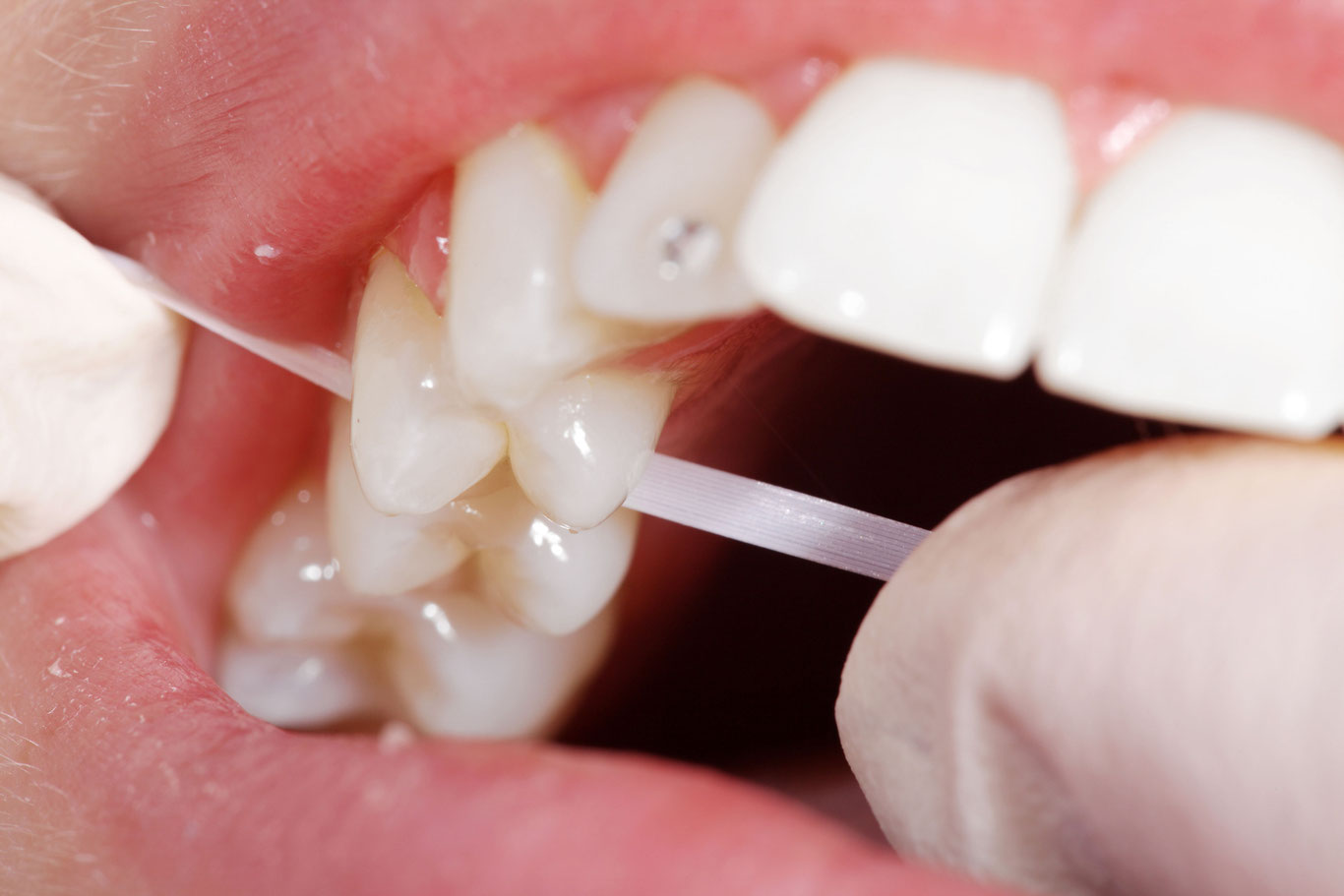 MUNDHYGIENE, professionelle Zahnreinigung - Zahnärztin Dr. Birck