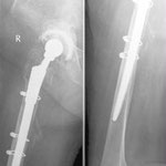 Heuprevisie totale heupprothese - De Heupkliniek Oudenaarde (Vlaamse ...