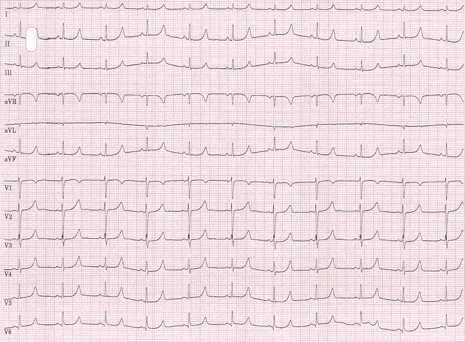 Long-QT-Syndrom - Fokus-EKG