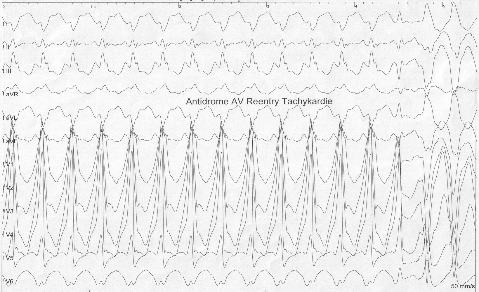 AV-Reentry-Tachykardie und ventrikuläre Präexzitation (WPW-Syndrom ...