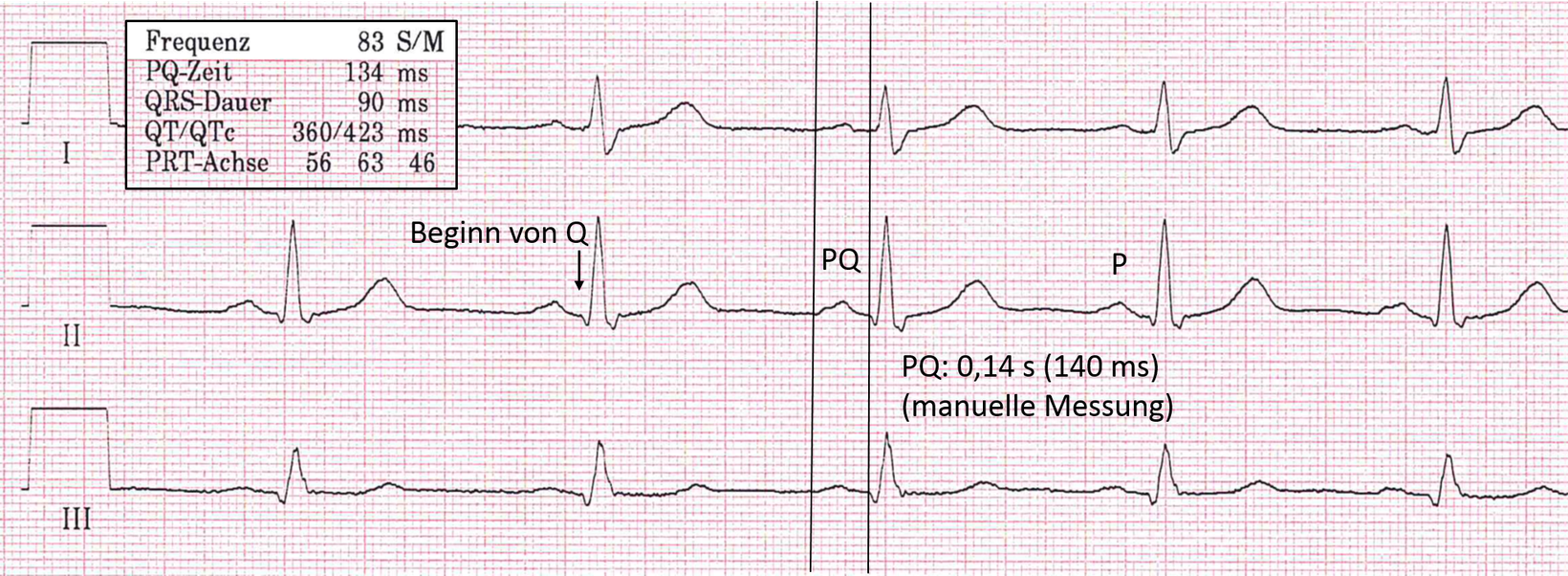 PQ-Intervall - Fokus-EKG