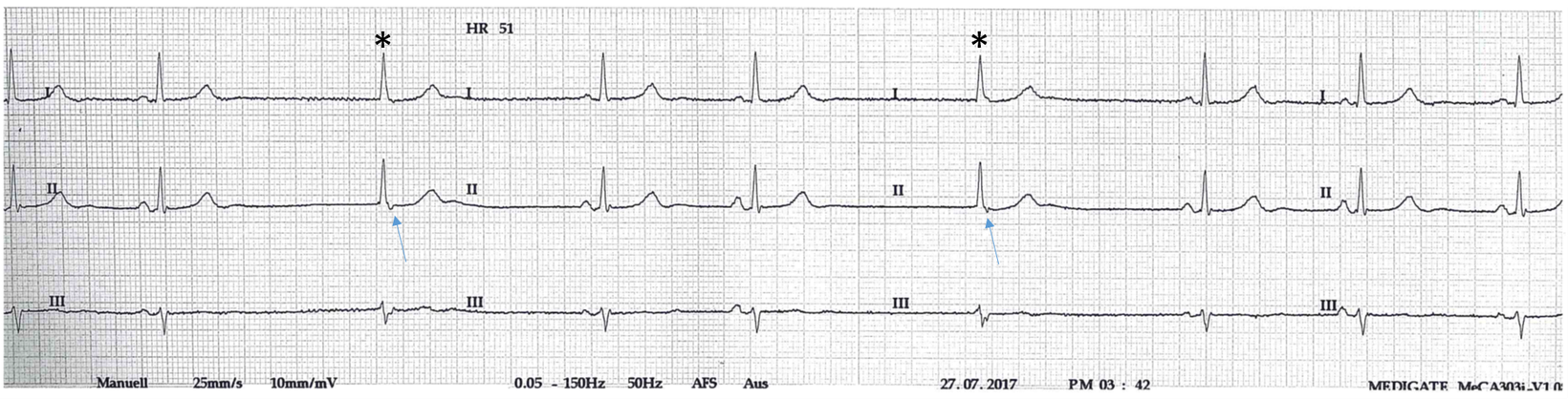 Sinuatriale Blockierungen - Fokus-EKG