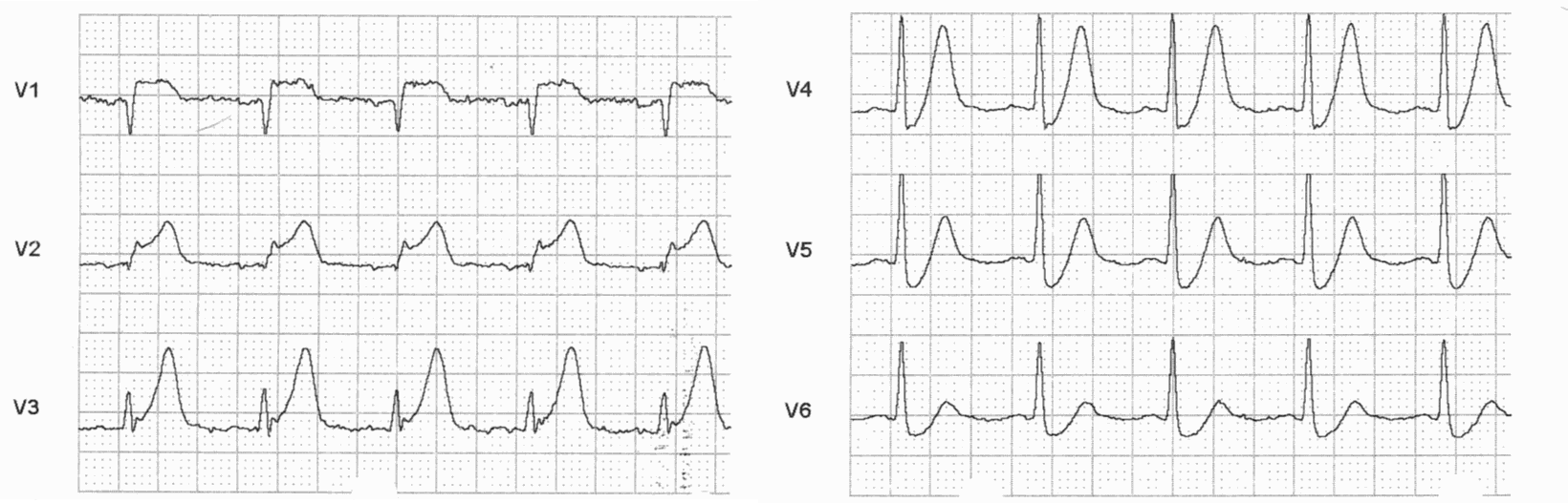 Myokardinfarkt - Fokus-EKG
