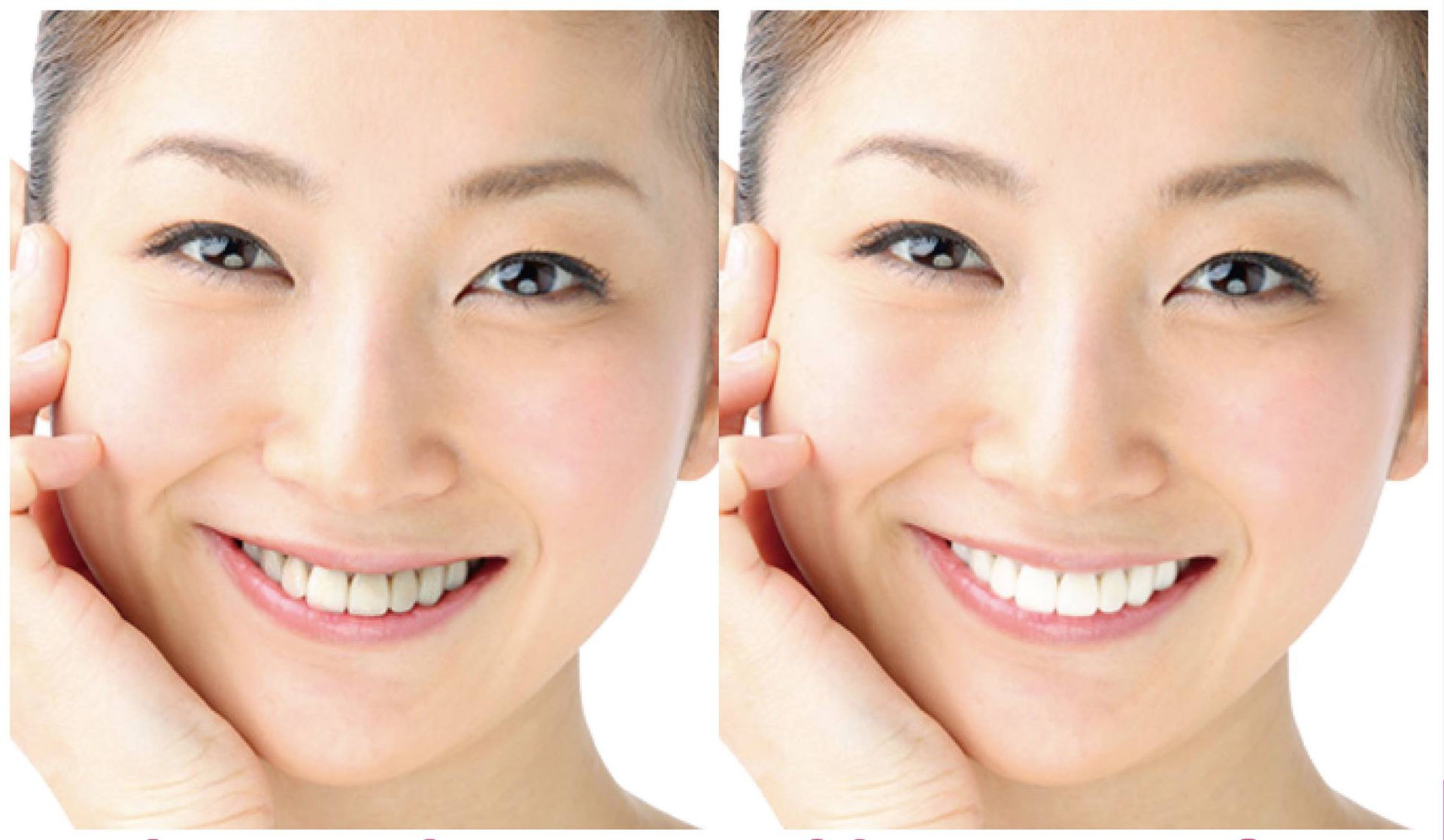 ホワイトニング(Whitening) - 茨木市 歯科 永井歯科医院 ホワイトニング(Whitening) - 茨木市 歯科 永井歯科医院