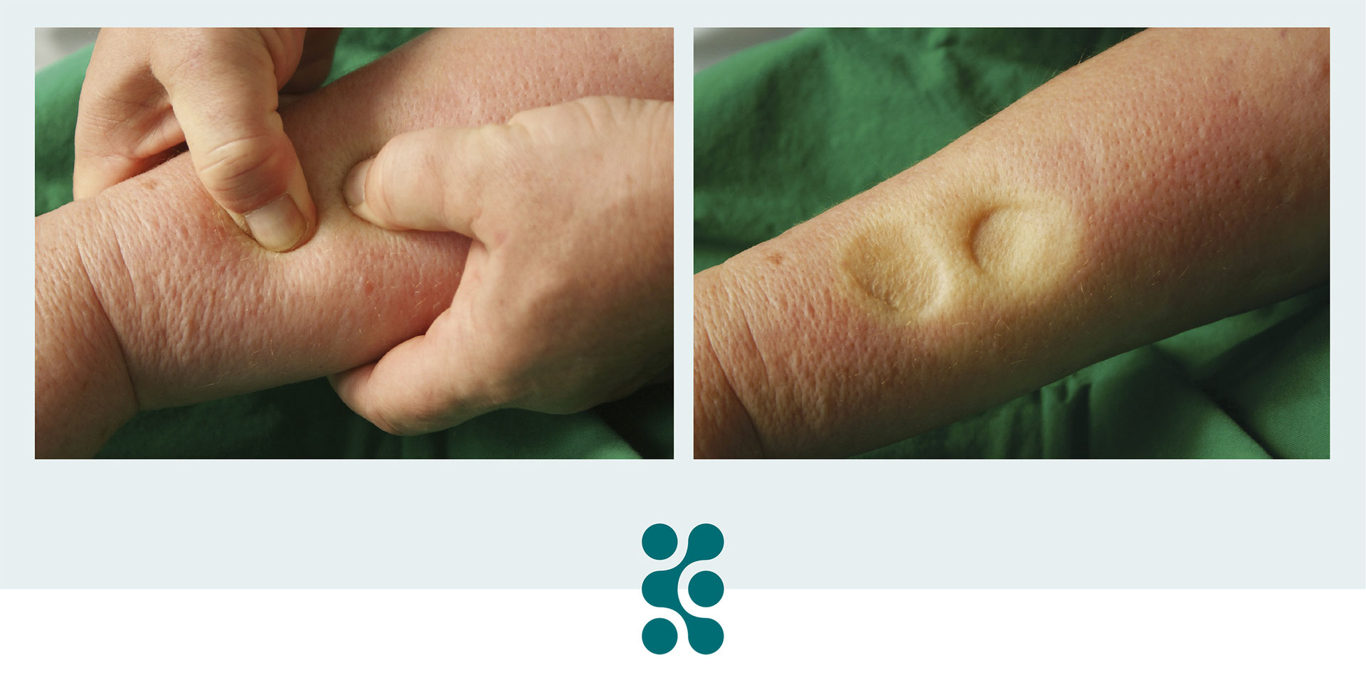 Lymphödem - Ursachen & Diagnose - CG Lympha