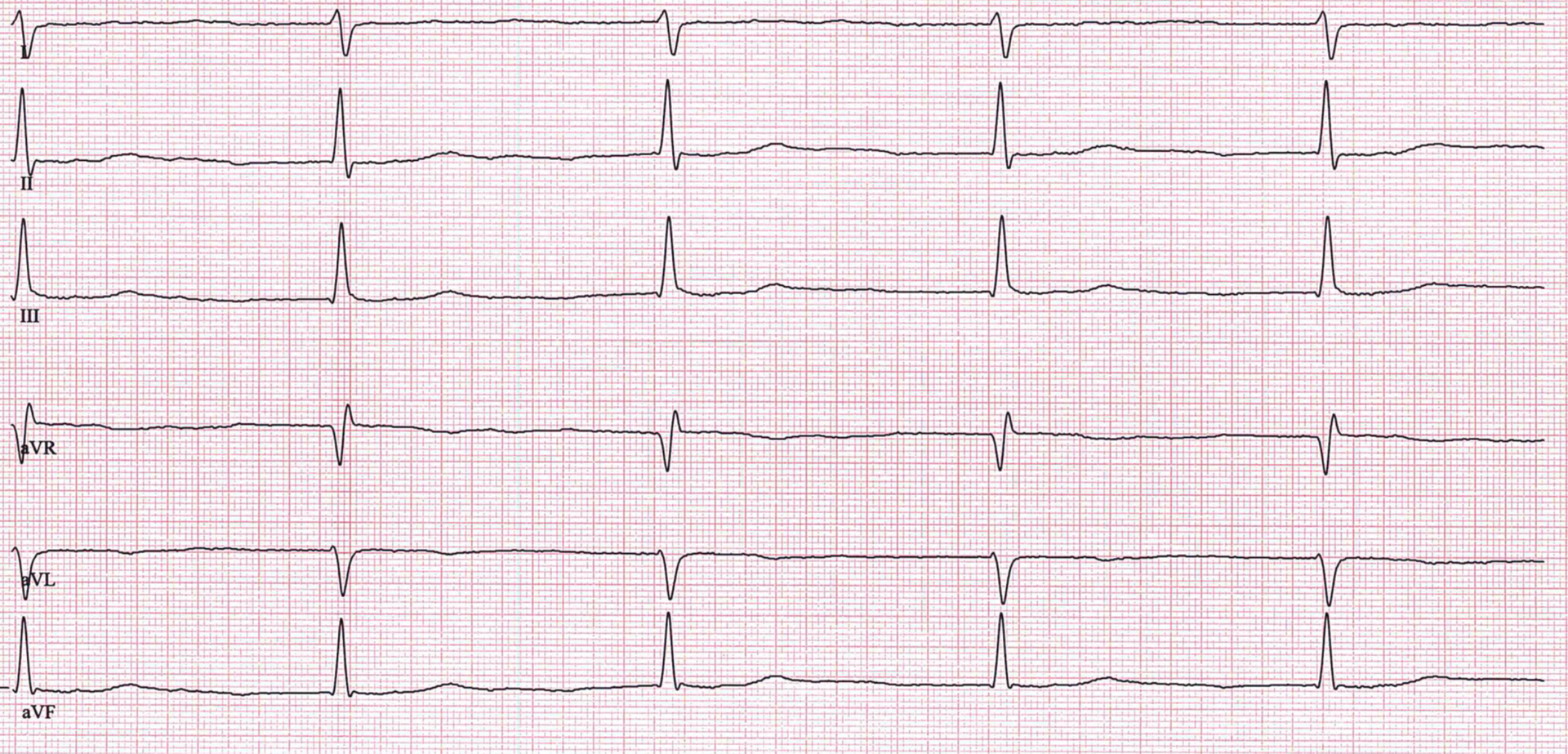 Ersatzrhythmen - Fokus-EKG