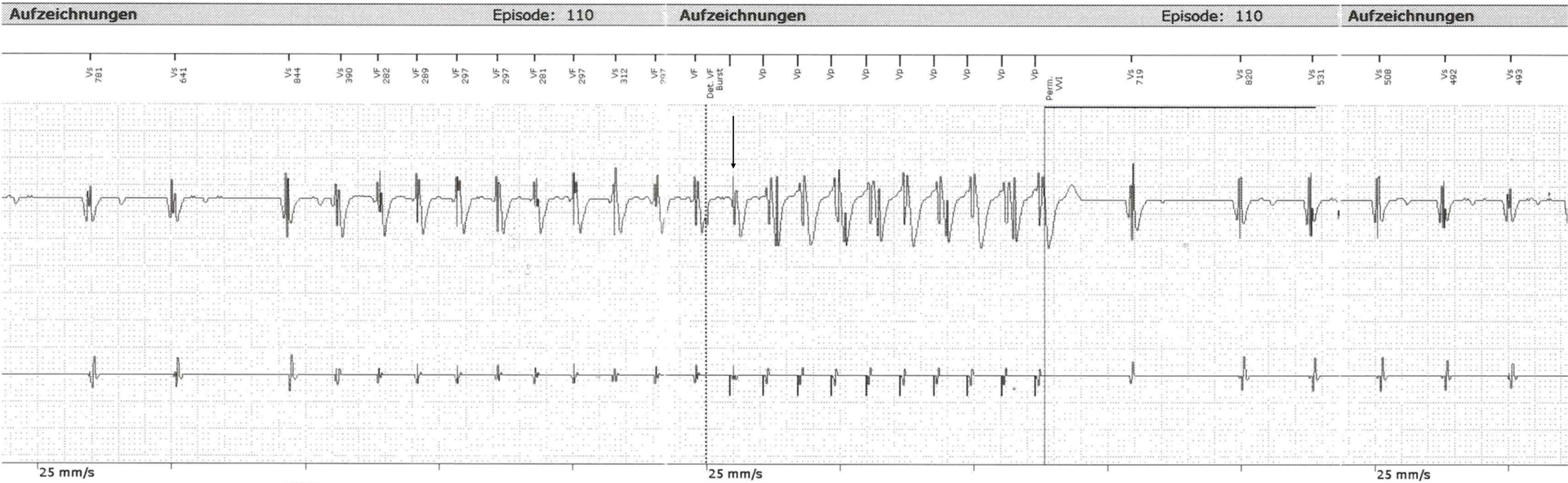 Implantierbarer Kardioverter/Defibrillator - Fokus-EKG