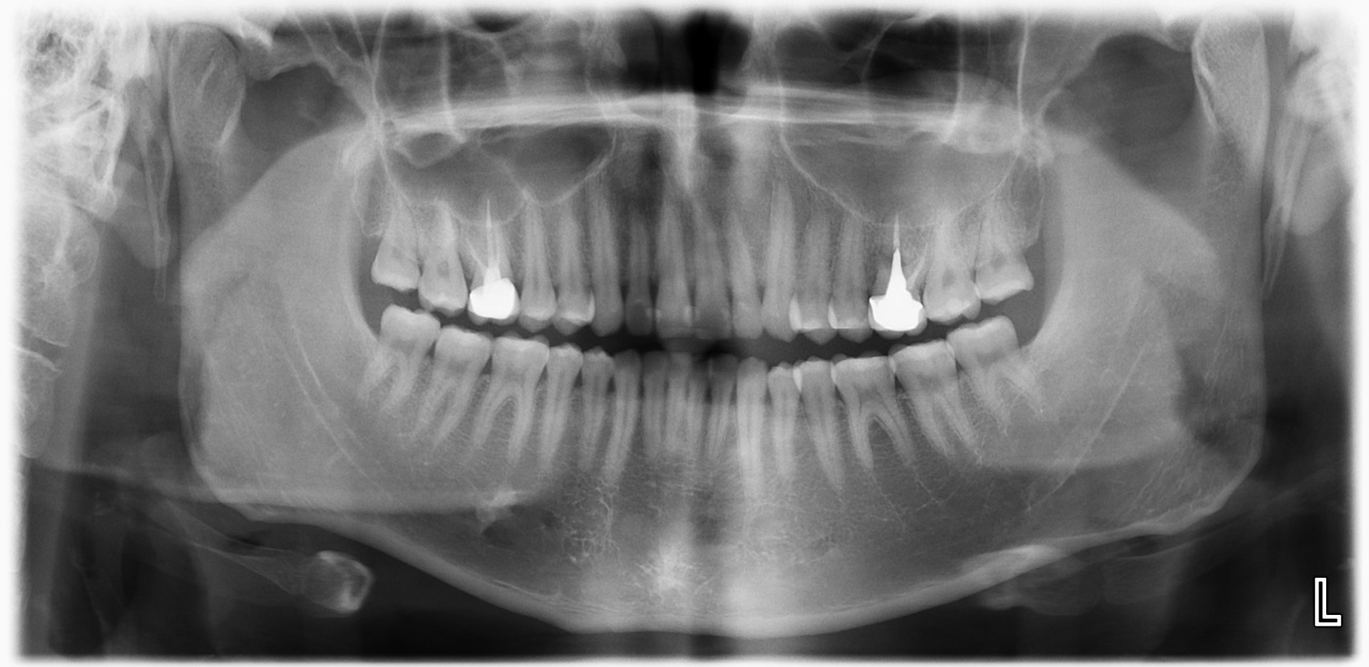 Caso Nº597: Reabsorción Radicular Externa Inflamatoria - CDI