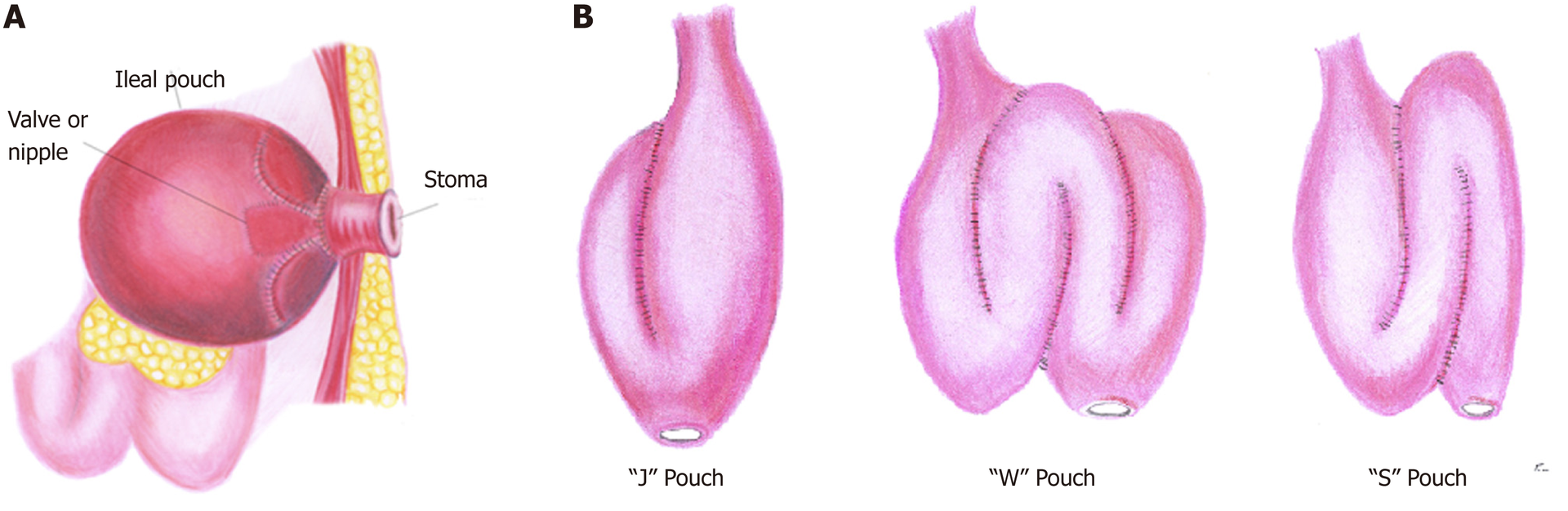kock pouch procedure