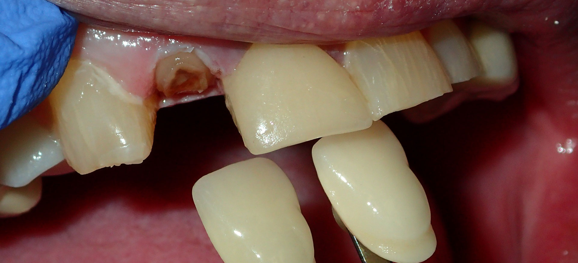 Wondering Why Your Front Tooth Broke Strong Family Dentistry Spanish wondering-why-your-front-tooth-broke-strong-family-dentistry-spanish