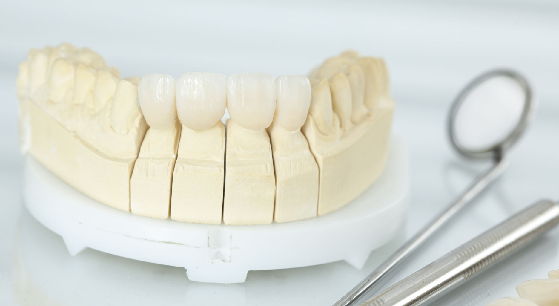 Inlays, Veneers - Zahnärztin Dr. Verena Altmann