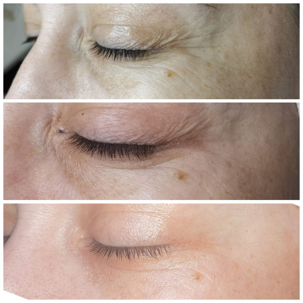 DSV-Line Kollagenfäden Behandlung - Auszeit Steffi Schuenemann