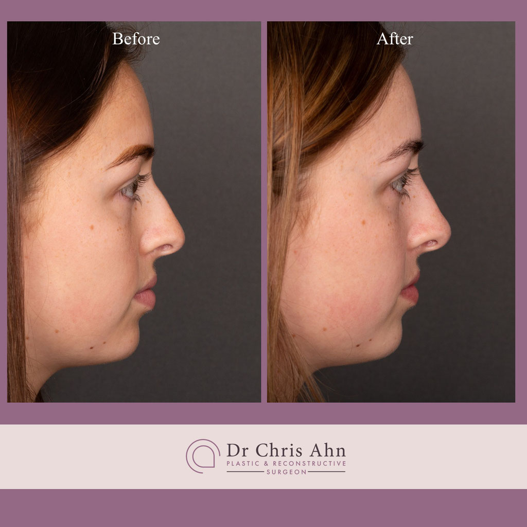 How To Make My Nose Bridge Higher Without Surgery Or Makeup | Saubhaya ...