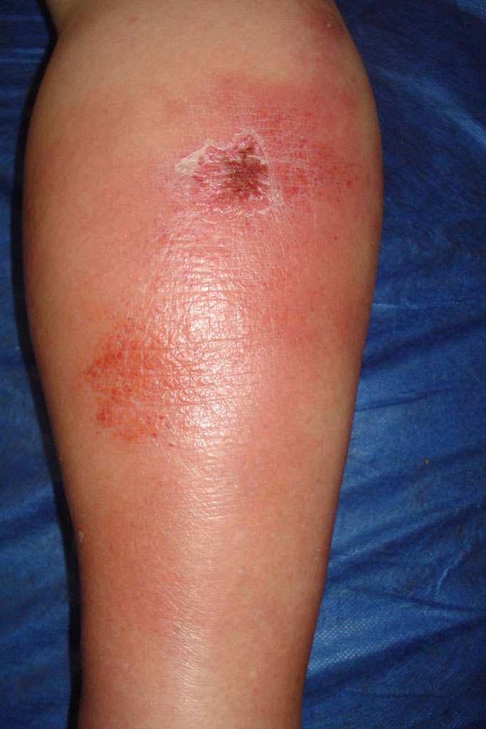 Flebitis alta - Página web de flebologiaylinfologialaplata