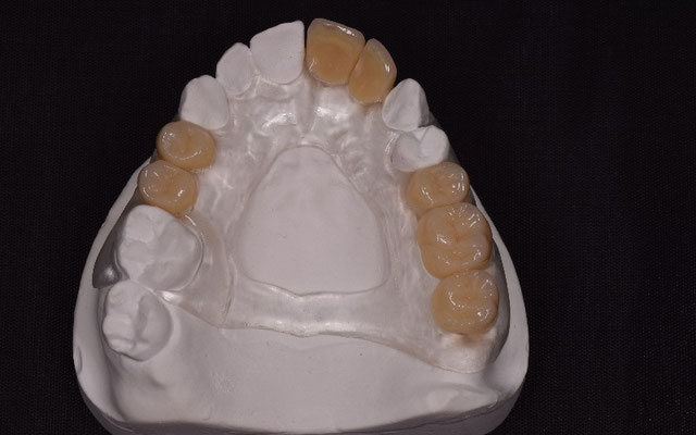 Aufbissschienen und Schnarcherschienen - DentalTeam Goller