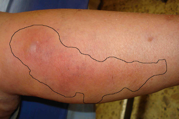 Flebitis - Página web de flebologiaylinfologialaplata