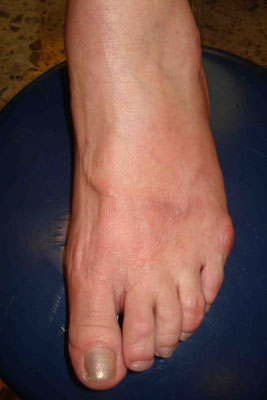 Flebitis - Página web de flebologiaylinfologialaplata