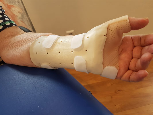 Spalktherapie bij hand-pols klachten - Fysio in Motion