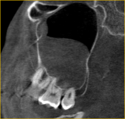 Caso N° 617: Pólipo Sinusal en Seno Maxilar Izquierdo - CDI