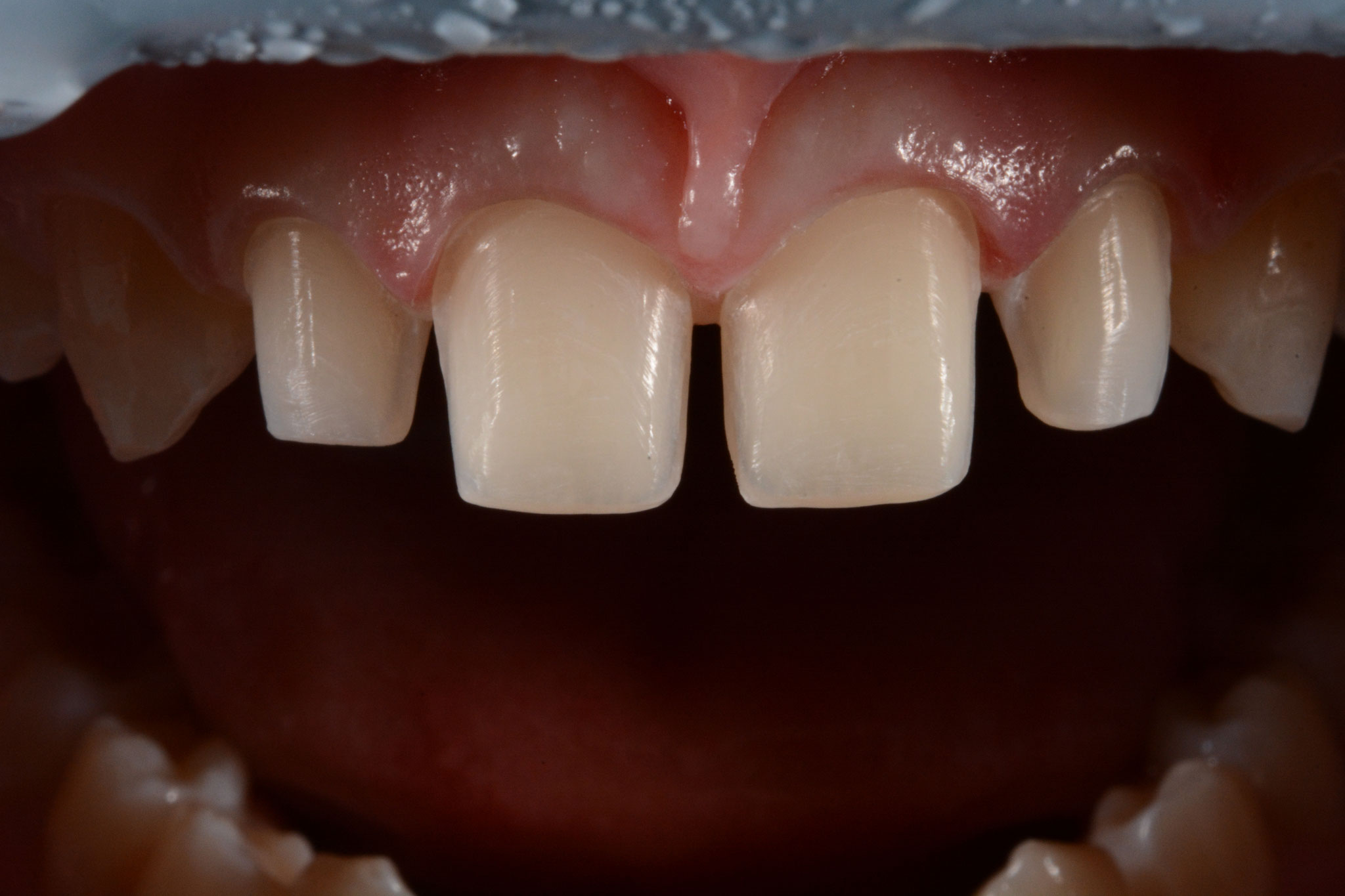 Facings - Ronald van der Linden Tandtechniek