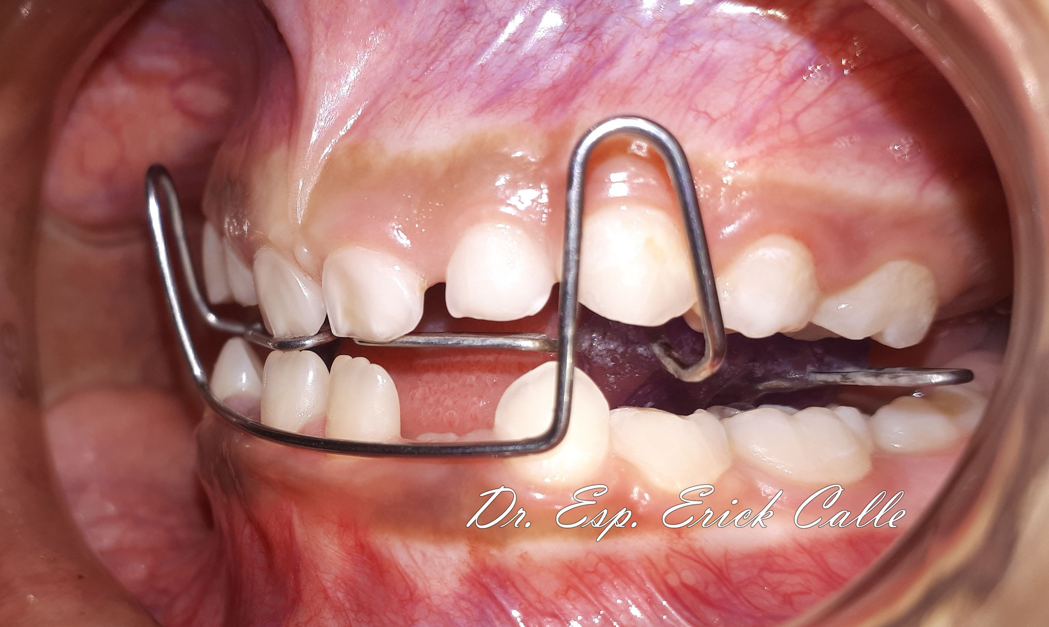 Mordida cruzada anterior: Diagnóstico y tratamiento con Placa Modelador ...