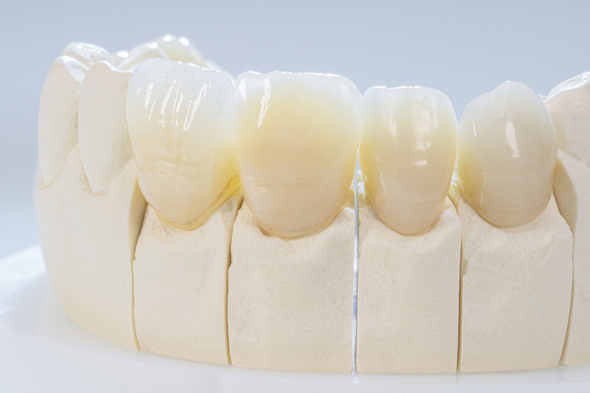 Kronen und Brücken – Völlig natürliche Ästhetik mit Vollkeramik ...