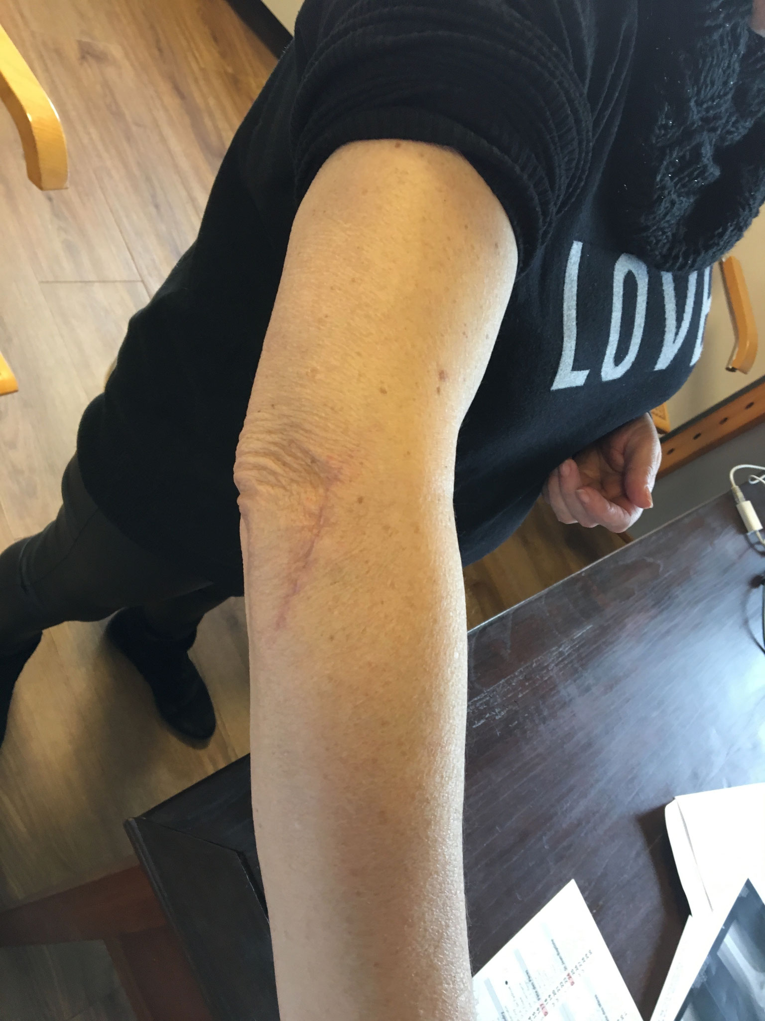 FRACTURE DU COUDE - Dr Rémi : chirurgien orthopédiste à Toulouse