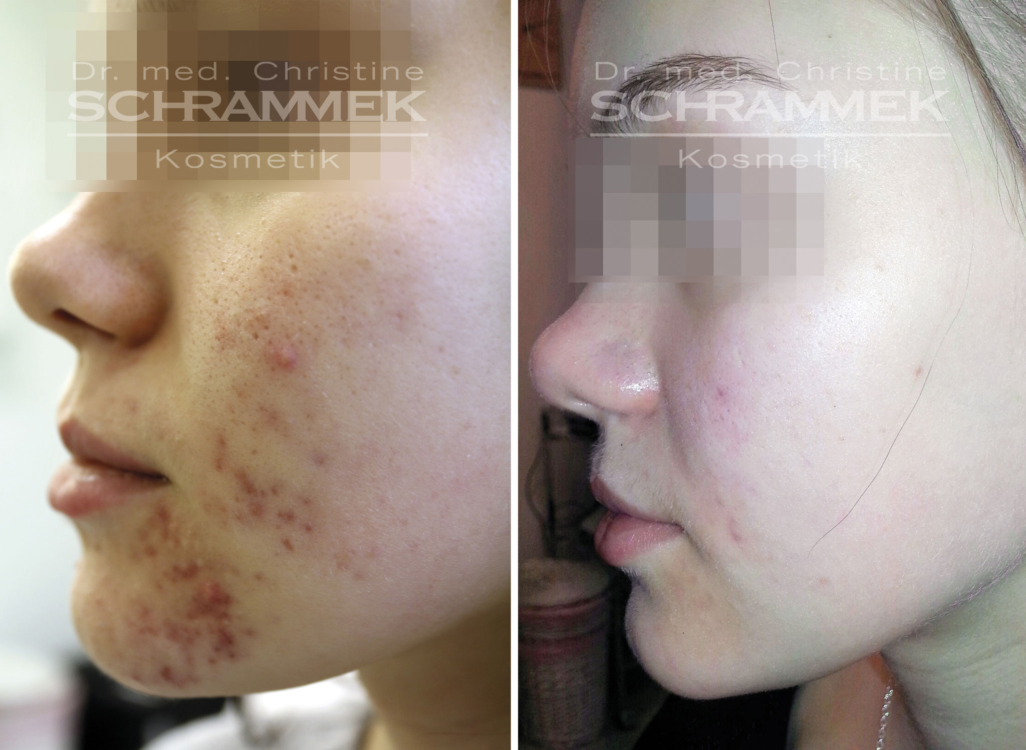 GREEN PEEL® Kräuterschälkur - Kosmetikstudio Auszeit Melanie Kurth ...