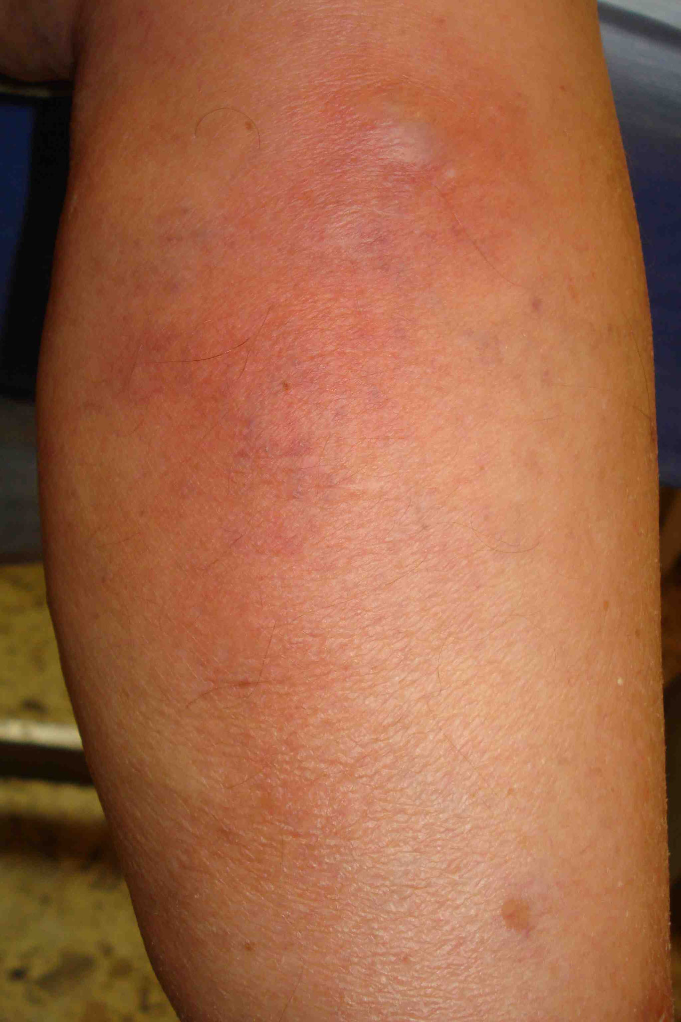 Flebitis alta - Página web de flebologiaylinfologialaplata