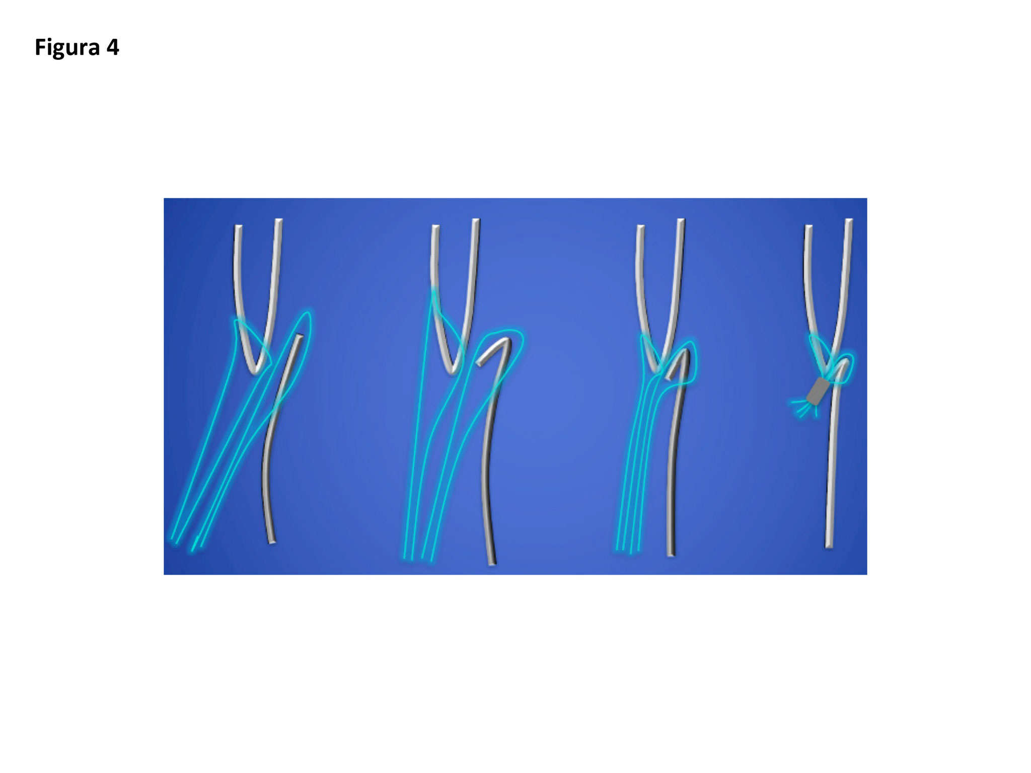 GASPARDONE E LA SUTURA DIRETTA. NobleStitch: TECNICA RIVOLUZIONARIA ...